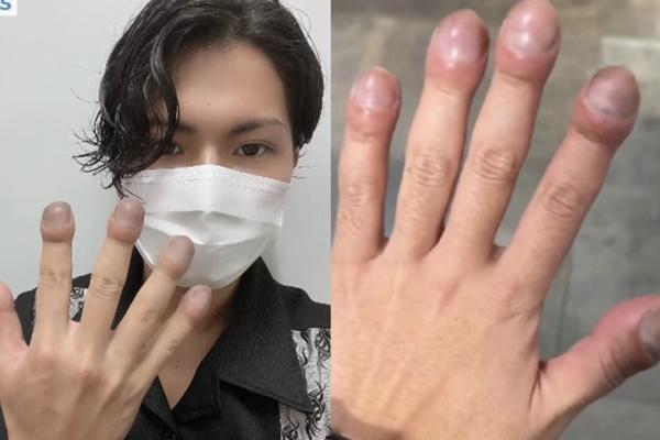 Nhà tạo mẫu tóc nổi tiếng vì ngón tay sưng to lạ lùng